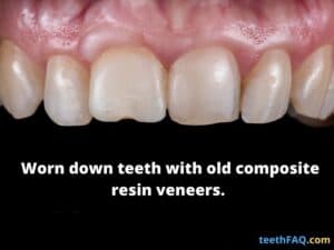 Temporary Crown Fell Off - What You Need to Do - Teeth FAQ Blog